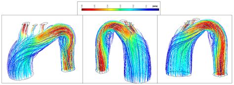 Fluids Free Full Text Aorta Ascending Aneurysm Analysis Using Cfd