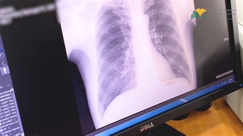 Songdo 360 Ковидын дараах цээжний рентген зураг ба компьютер шинжилгээ 📌📌📌 14 хоногийн өмнө