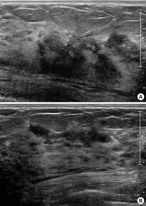 Increased Malignant Microcalcifications After Neoadjuvant Chemotherapy