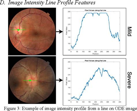 Figure 1 From Automatic Severity Grading Of Optic Disc Edema Using