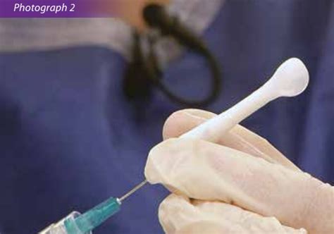 Treatment Of A Bartholin Gland Abscess A Step By Step Approach