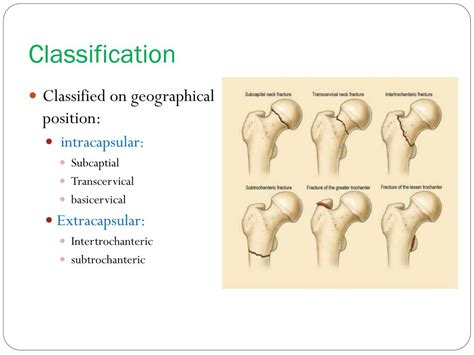 Ppt The Hip Fractures Powerpoint Presentation Free Download Id 6661120