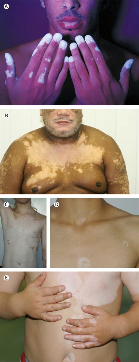 Vitiligo The Lancet