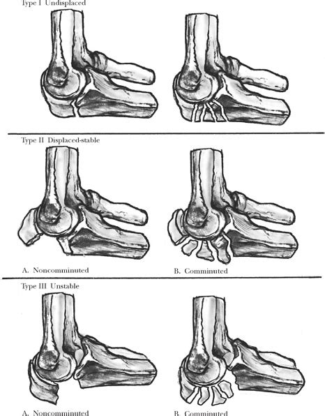 Mayo Classification System Of Olecranon Fractures