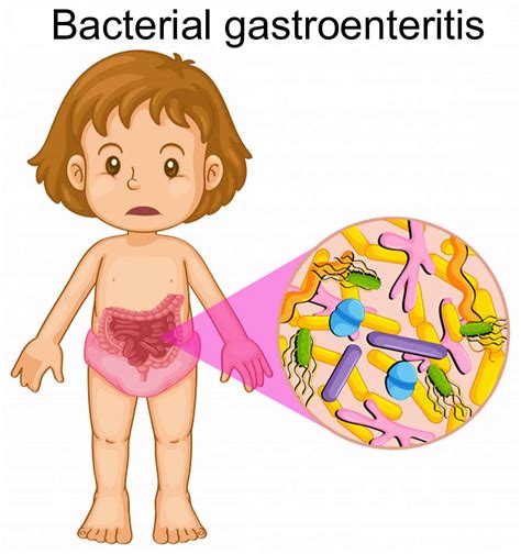 Bacterial Gastroenteritis Causes Symptoms Diagnosis Treatment And Prognosis