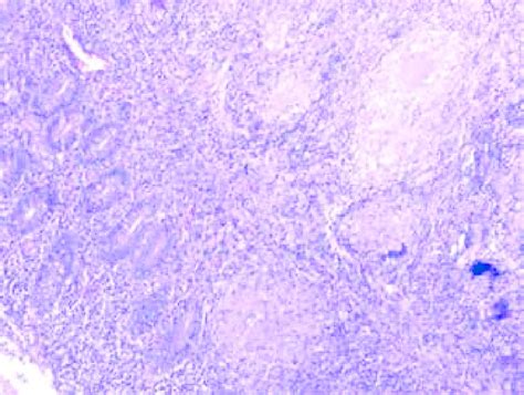 Microphotograph Showing Mucosa Of Appendix Infiltrating With