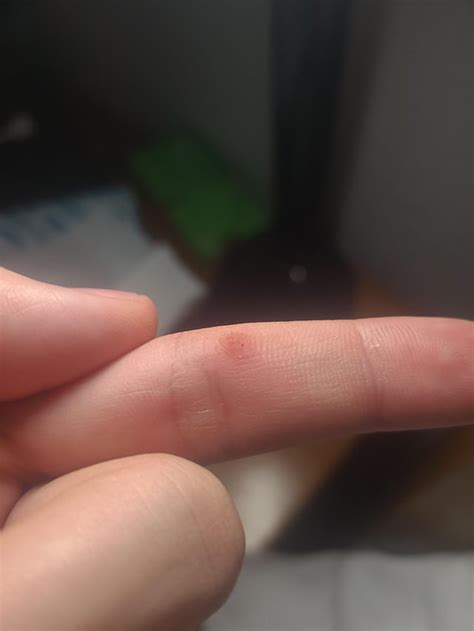 Weird Bump On My Finger Rmedicaladvice