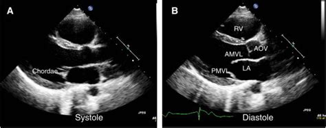 Echocardiography Of The Mitral Valve Pmc