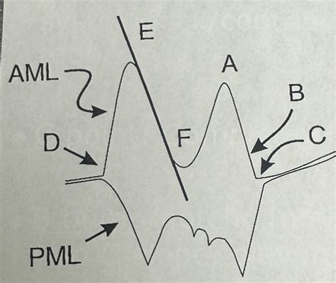 Mitral Valve M Mode Flashcards Quizlet