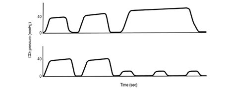 Capnograms Indicating Two Types Of Hypoventilation The Waveform In A