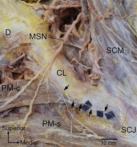Supraclavicular Nerve Cadaver Supraclavicular Nerve Cadaver