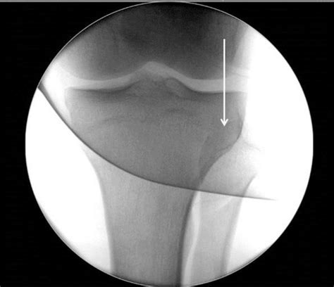 Proximal Tibiofibular Dislocation A Case Report Of This Often