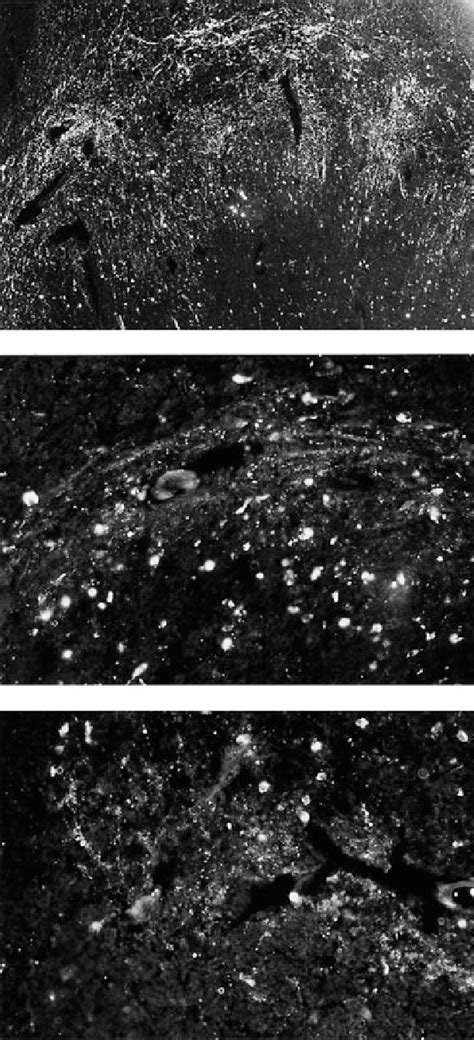 Table 1 From Neuropeptide Expression In The Human Trigeminal Nucleus Caudalis And In The