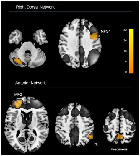 Sex Differences In Fronto Parietal Networks Main Effect Of Sex Was Download Scientific Diagram