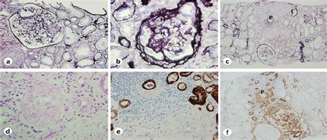A An Enlarged Glomerulus With Slightly Hyperplastic Juxtaglomerular Download Scientific