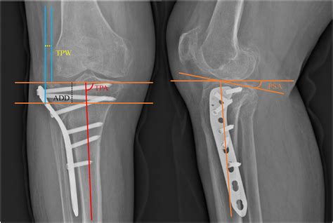 Outcomes After Orif Are Similar In Young And Elderly Patients With Tibial Plateau Fractures A