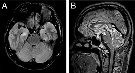 Mri Scans Of He Patients A And B Patient No4 With Memory