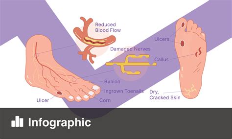 Diabetic Peripheral Neuropathy The Forgotten Complication Of Diabetes