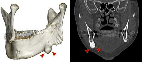 Inferior Border Of Mandible