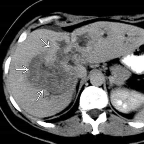 Peripheral Intrahepatic Cholangiocarcinoma Clinical Gate