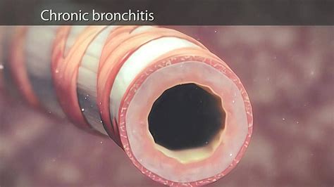 Bronchitis Background Images Hd Pictures And Wallpaper For Free Download Pngtree