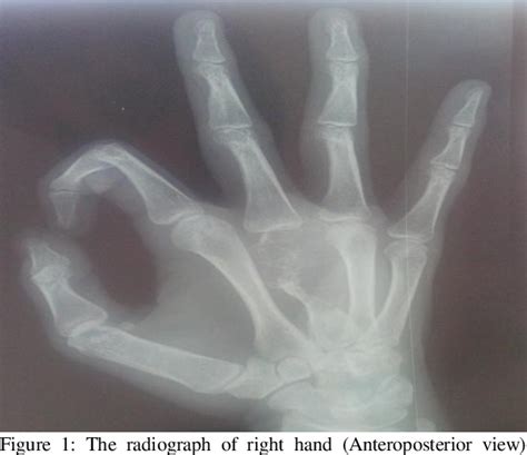 Figure 1 From Giant Cell Tumor Of Metacarpal Bone With Aggressive Behavior Semantic Scholar