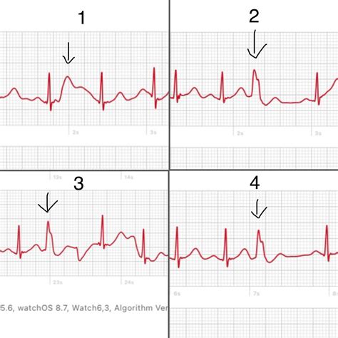 Having Flutters In Chest And Neck Caught These At Each Palpitation On A Few Different Ekgs