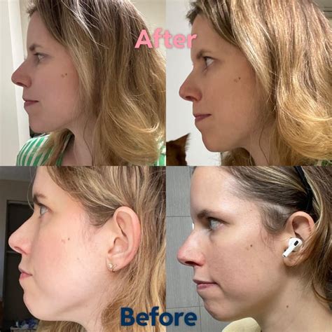 Before And After Chin Botox R Plasticsurgery