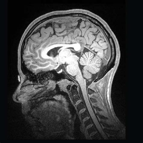 Insights From Genetic Autism Brain Scans