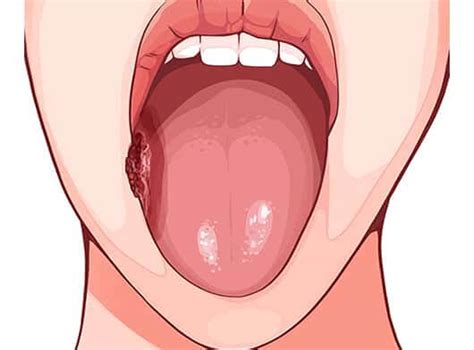 Spotting Mouth Ulcers Vs Oral Cancer Early Signs