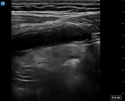 Ruptured Appendix Ultrasound Epos™