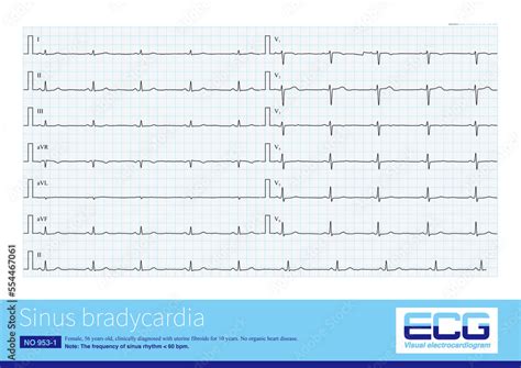 Sinus Bradycardia Refers To The Frequency Of Impulses Issued By The