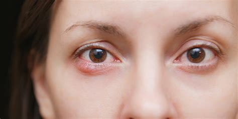 Chalazion Aoa