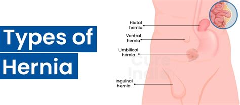 Hernia Surgery In India Best Doctors Hospitals And Treatment Cost