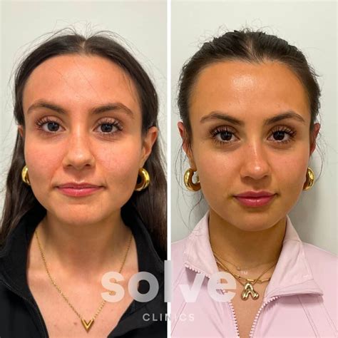 Masseter Botox Transform Your Jawline Masseter Botox Benefits