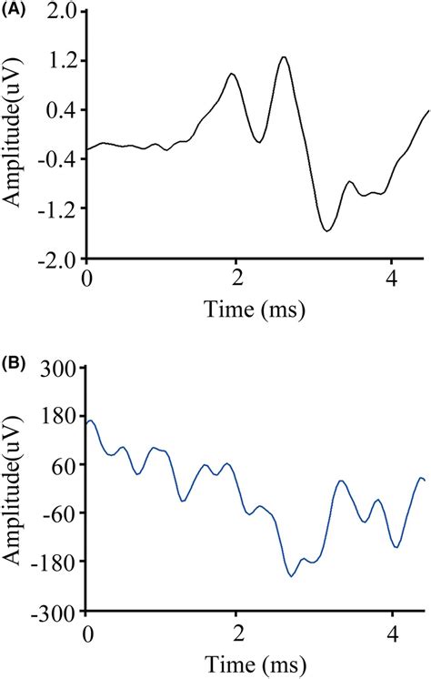 Typical Abr Waveforms In The Nihl Group And Hcs Group At 6 Months Download Scientific Diagram