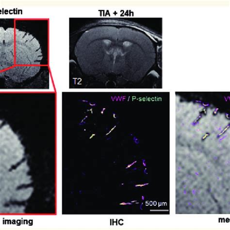 High Resolution Molecular Mri Of P Selectin Positively Diagnoses Tia Download Scientific