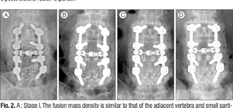 Figure 2 From Radiographic Analysis Of Instrumented Posterolateral