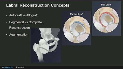 Hip Labral Reconstruction Evolution To Labral Reconstruction Orthopedia