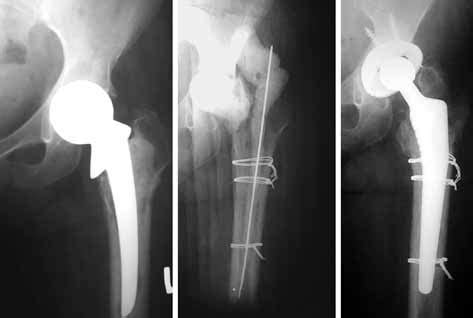A 62 Year Old Female With Infected Thompson Prosthesis B 1 St