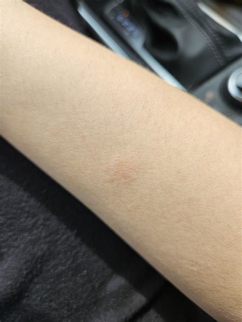Raised Patch And Not Itchy More Than 2 Weeks Now Any Idea R Skincareaddicts
