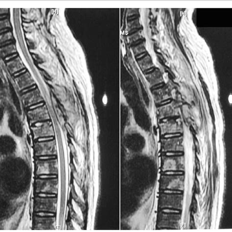 India Ink Staining Of The Pus Culture The Cryptococcus Can Be Found In Download Scientific