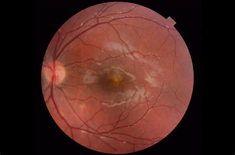Vitelliform Lesion That Appeared Several Days After Exposure