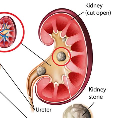 انواع سنگ کلیه را بشناسید حس خوب آسمان