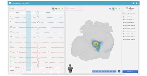 Vektor Medical Announces New Cpt Code For Novel Noninvasive Arrhythmia Analysis Using Vmap