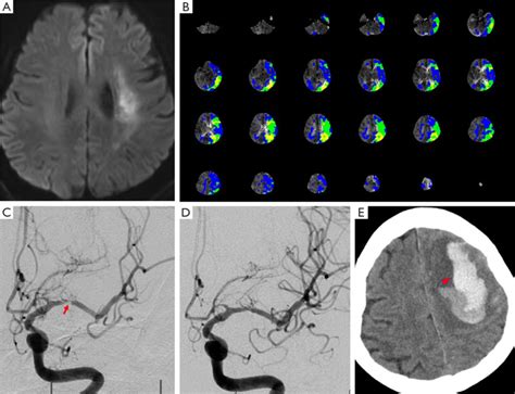 An Example Of Hps After Intracranial Stenting An Adult Patient
