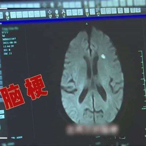 70多岁的阿公4年突发2次脑梗，千万别再忽略这个因素！台州