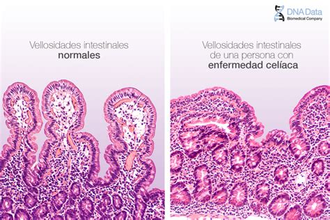 Enfermedad Celíaca La Enfermedad Silenciosa Dna Data