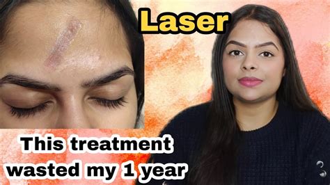 My Scar Treatment Laser Treatment Shivani Yadav Cambridge Breast