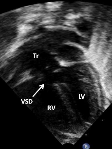 Truncus Arteriosus Echo